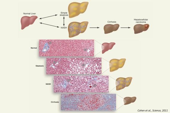 New Mechanisms of Non-Alcoholic Fatty Liver Disease | UT Southwestern ...