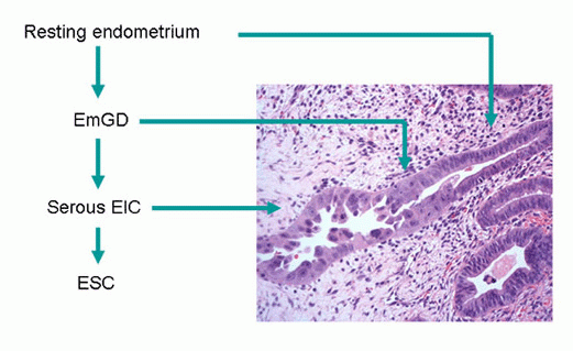 Precursors of Type II Endometrial Cancer | Zheng Lab | UT Southwestern ...